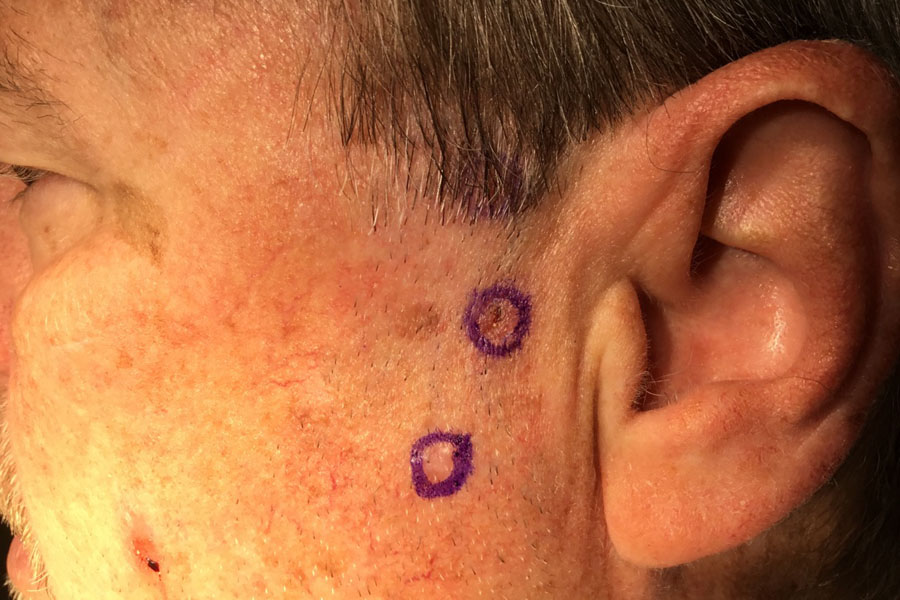 Mohs Surgery Procedure Gallery | Baucom & Mina Derm Surgery, LLC Mohs Surgery Procedure Gallery | Baucom & Mina Derm Surgery, LLC